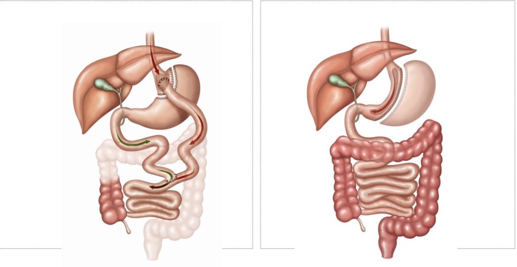 gastric bypass technique - USUL-Health